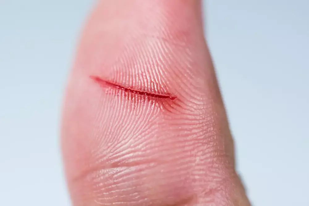 injuries and accident. Interactive worksheet | TopWorksheets